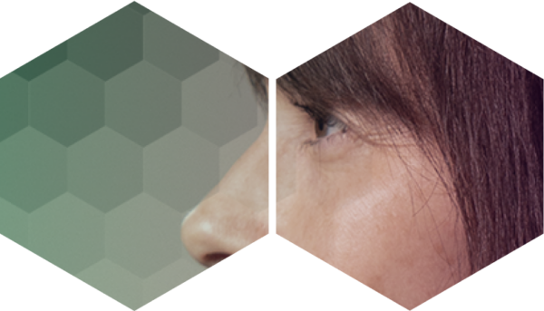 Oxylanthanum Carbonate (OLC) - Unicycive